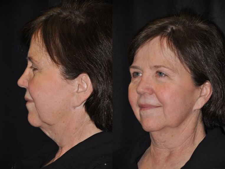Neck-Lace Before and After Photos Before and After Photos | Plastic ...