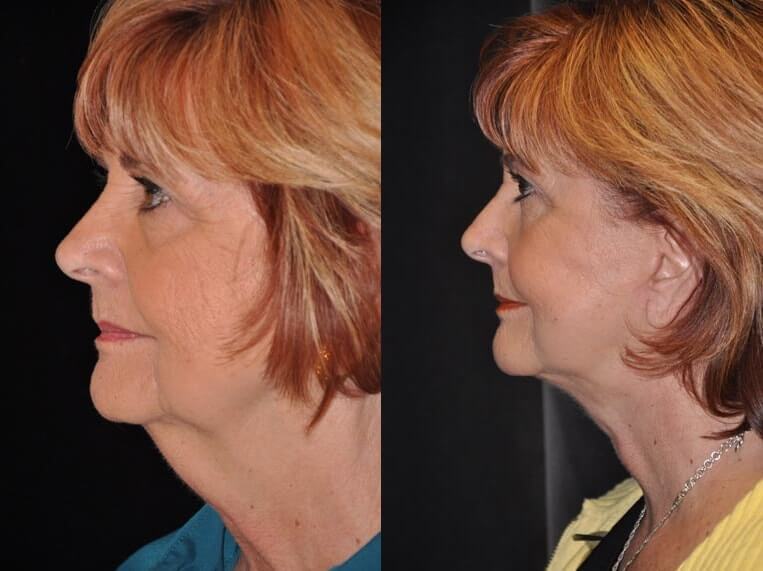 Neck-Lace Before and After Photos Before and After Photos | Plastic ...