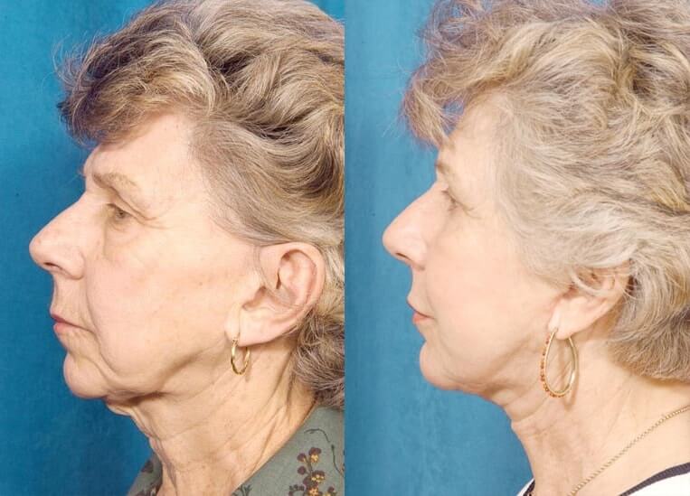Necklift Before and After Photos Before and After Photos | Plastic ...