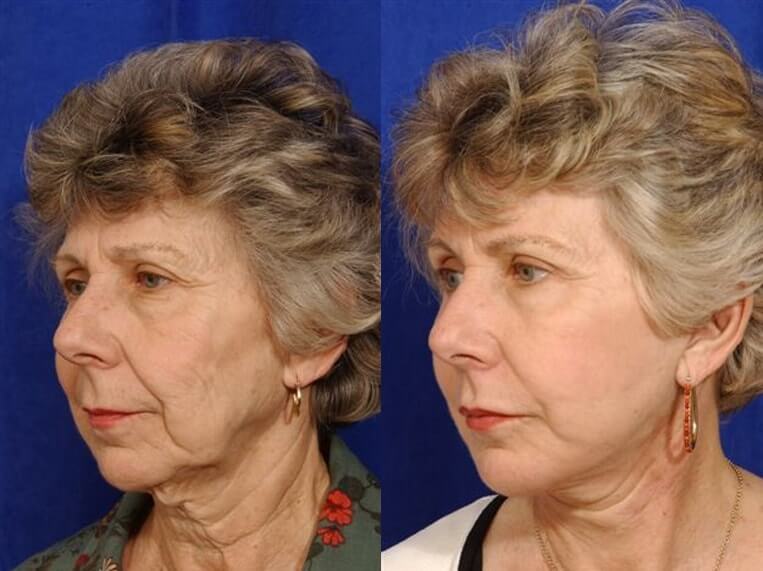Facelift 360 Before and After Photos | Plastic Surgery of Santa Barbara