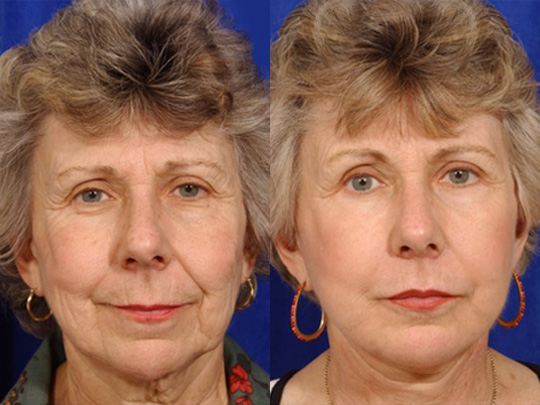 Laser Skin Resurfacing Before and After Photos Before and After Photos ...