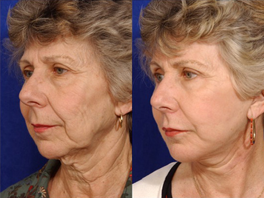 Laser Skin Resurfacing Before and After Photos Before and After Photos ...